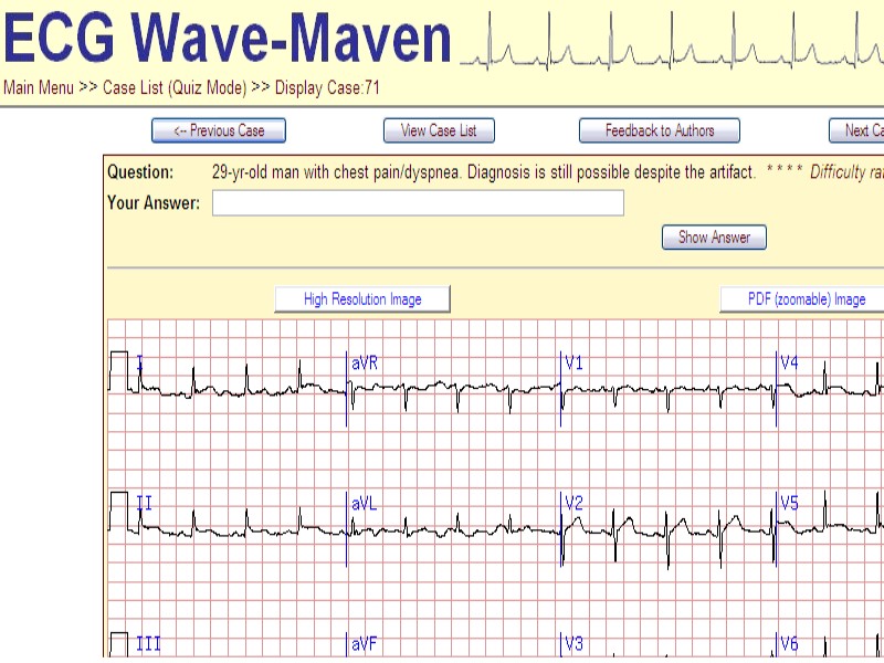 Fil:20141107105922!Ecg wave maven.jpg – JournalWiki