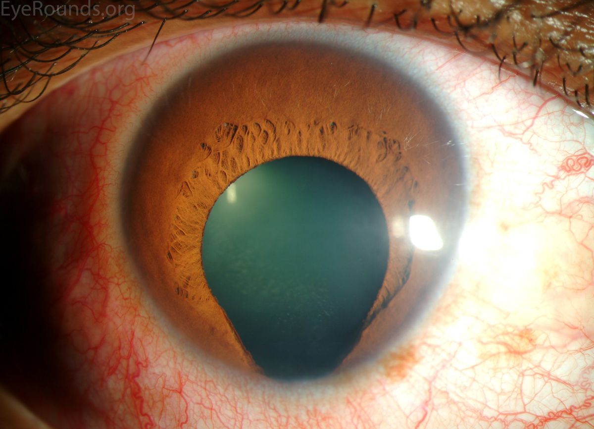 Colobom – JournalWiki