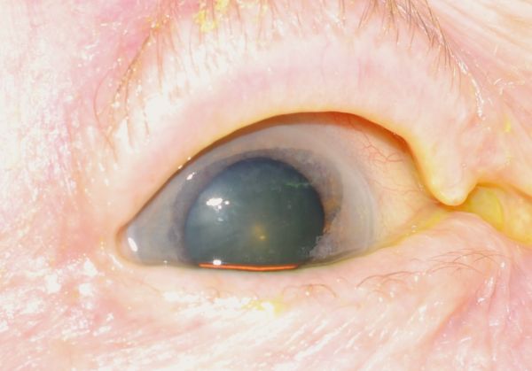 Katarakt – JournalWiki