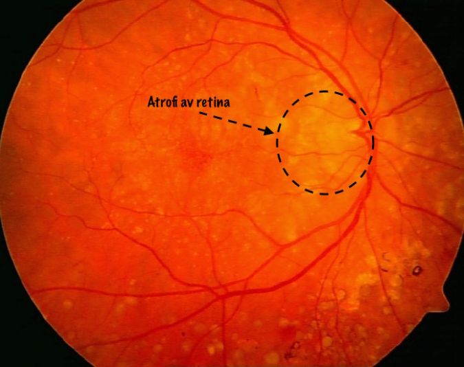 Papillen og retina – JournalWiki
