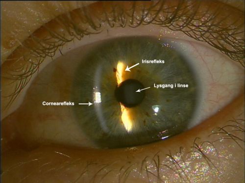 Øyeundersøkelse/Conjunctiva, cornea, iris og forkammer – JournalWiki