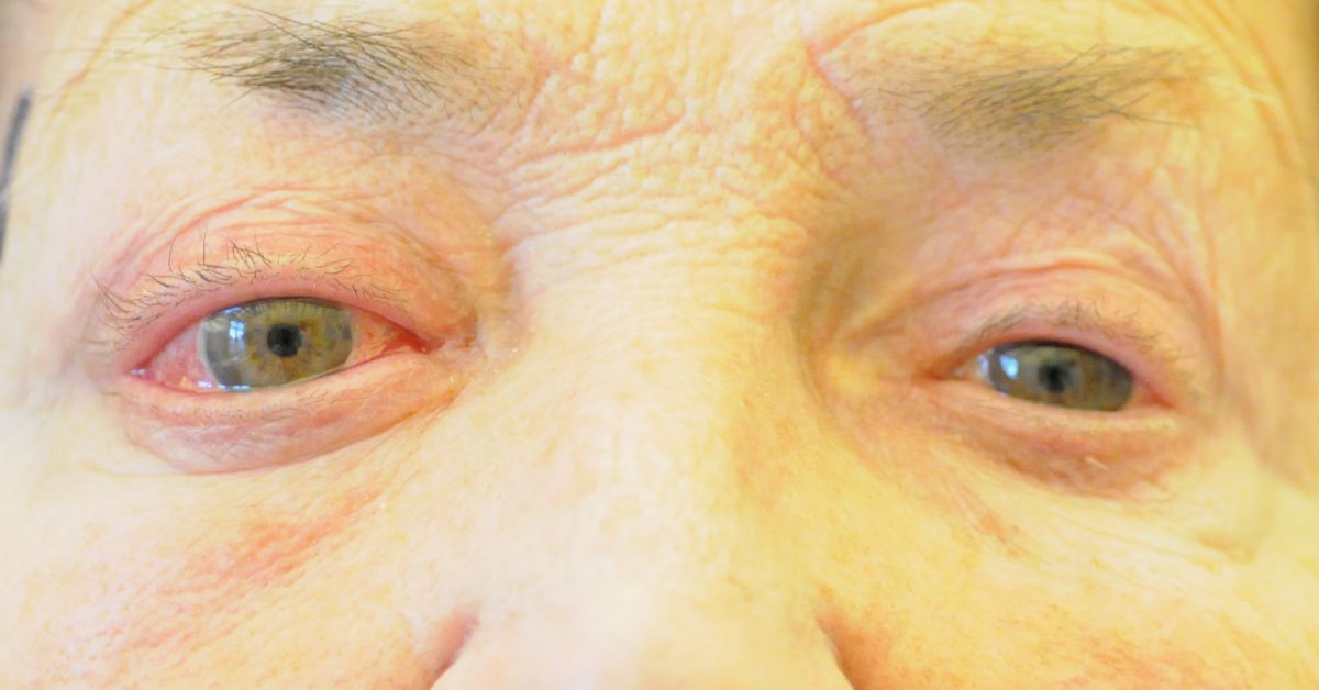 Eksoftalmus – JournalWiki