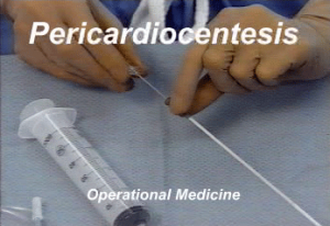 Fil:Perikardiocentese.mp4 – JournalWiki