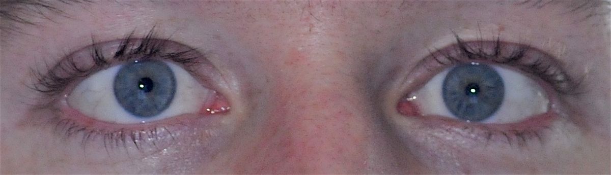 Fil:Esotropi.jpeg – JournalWiki